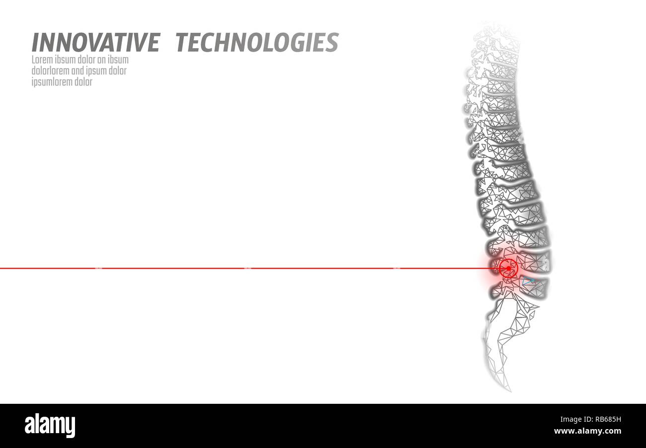 Laser physiotherapy human spine injury. Pain area surgery operation ...