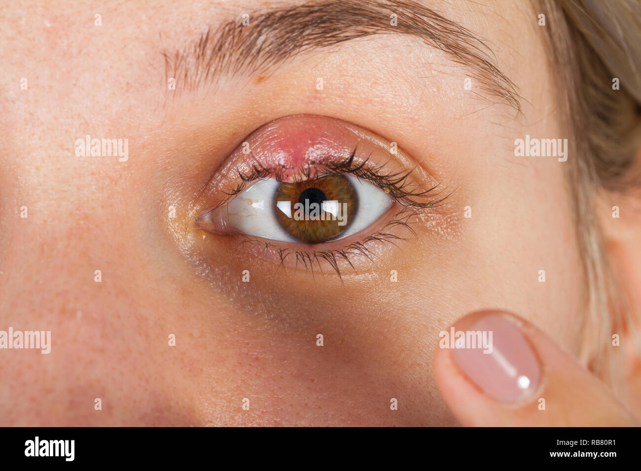 Staph Infection In Eye at Tyson Bathurst blog