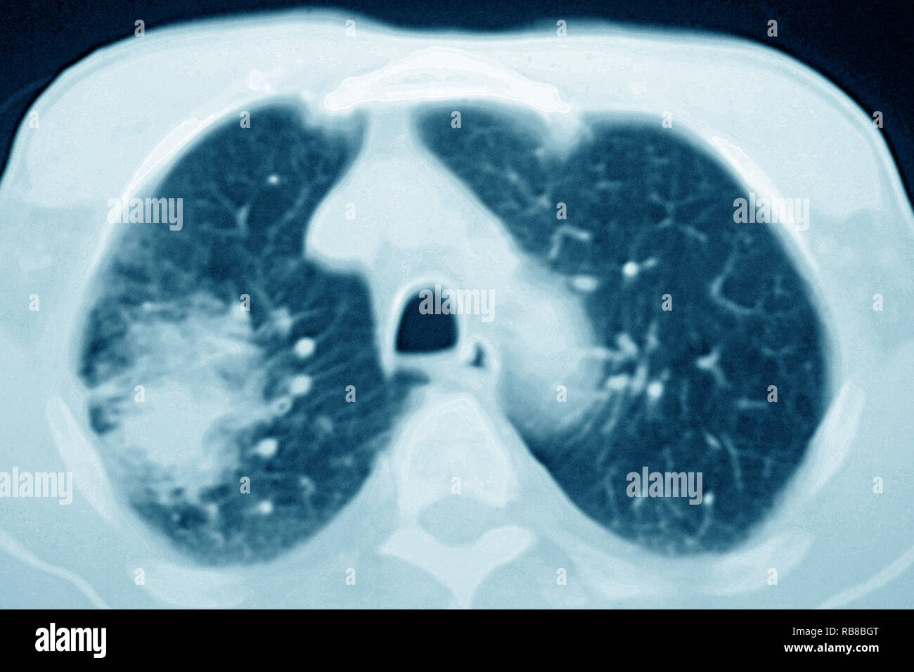 LUNG CANCER MRI Stock Photo - Alamy