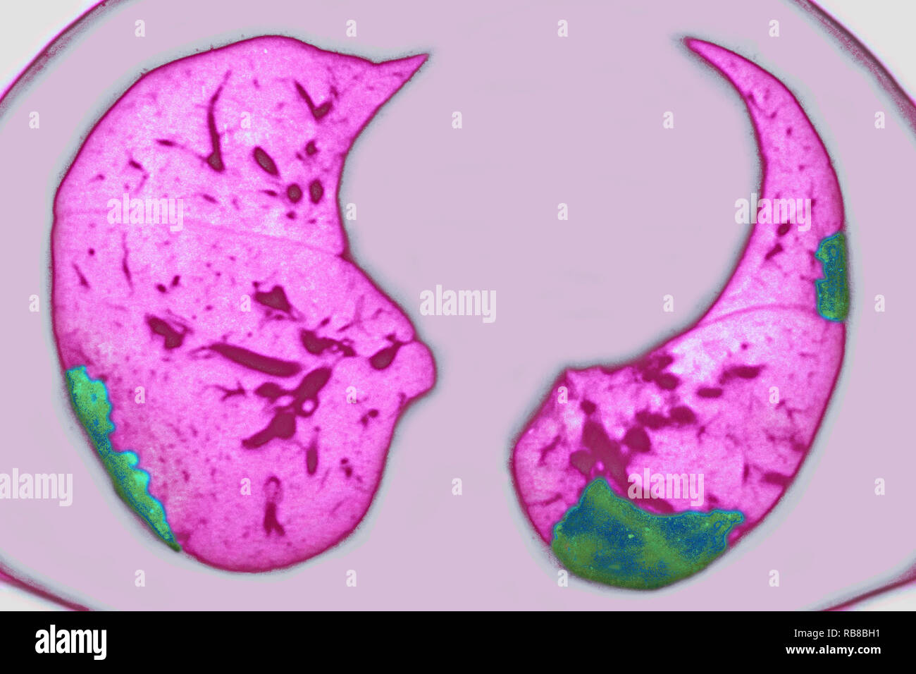 PULMONARY INFARCTION CT SCAN Stock Photo - Alamy