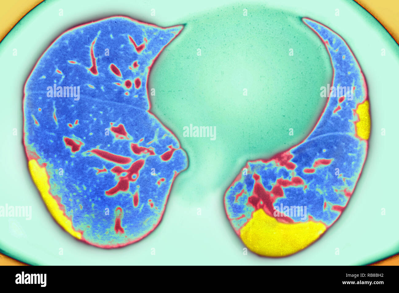 PULMONARY INFARCTION CT SCAN Stock Photo - Alamy