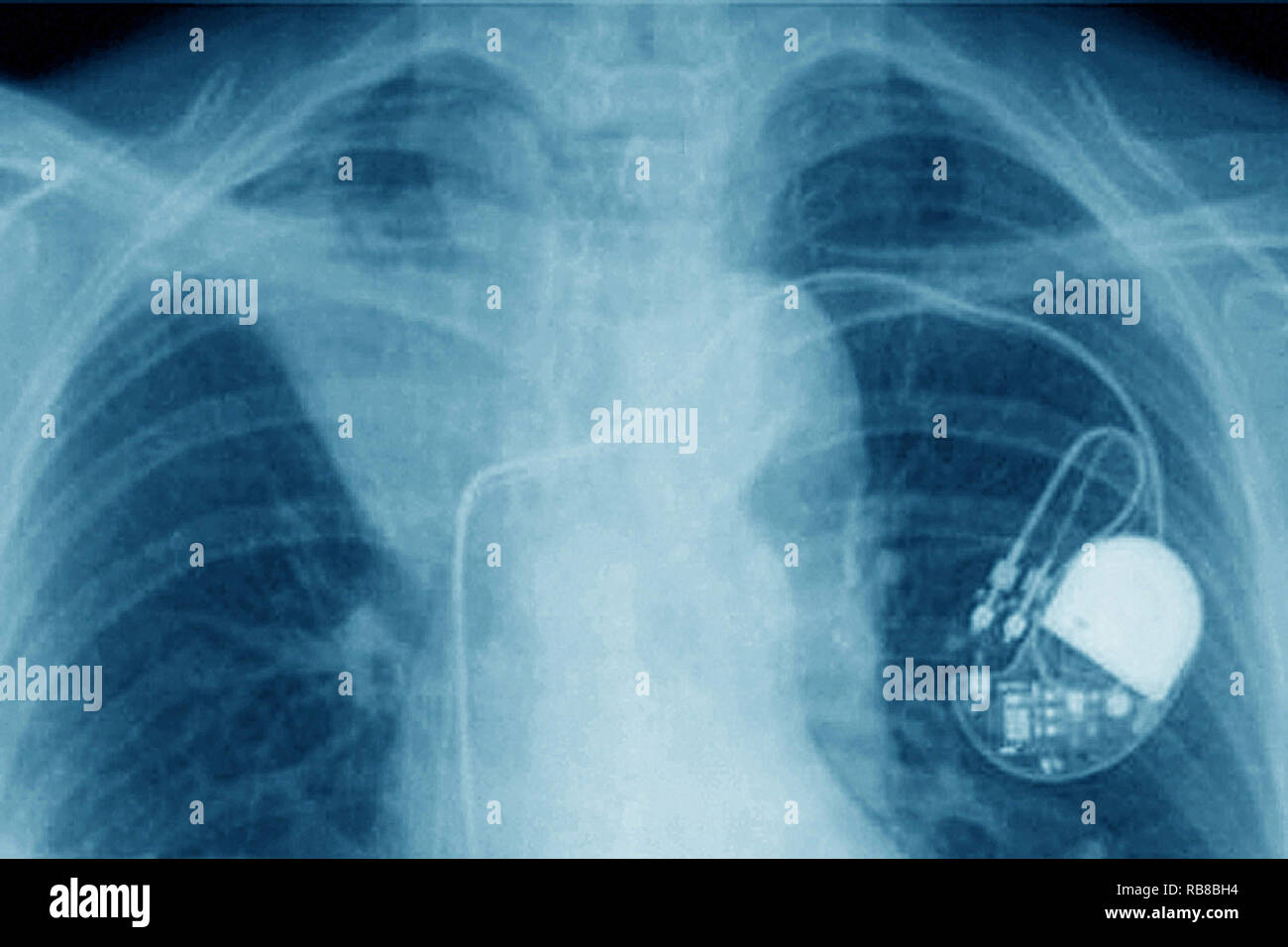 Pacemaker hi-res stock photography and images - Alamy