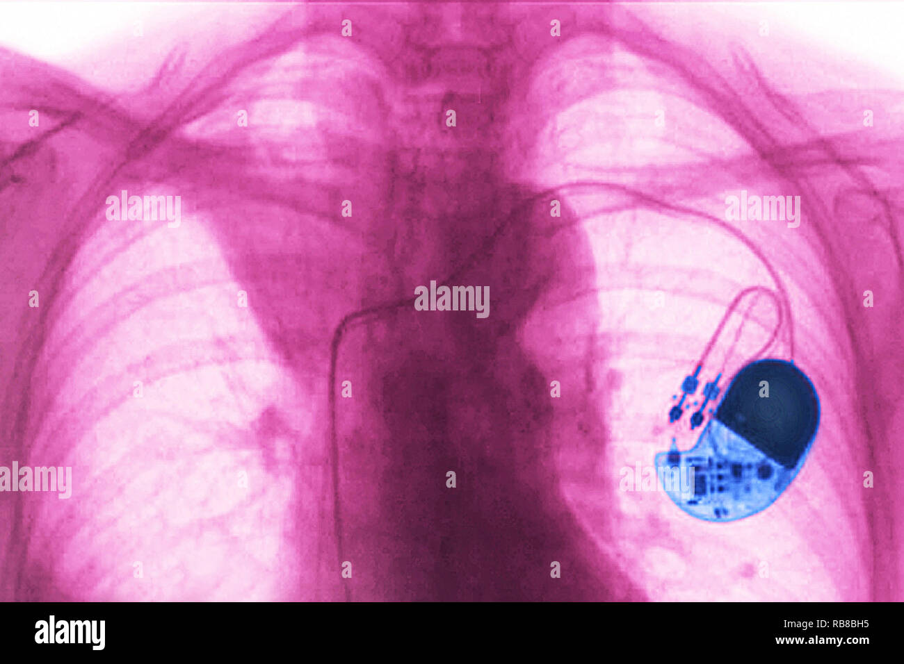 Implant Pacemaker High Resolution Stock Photography and Images - Alamy