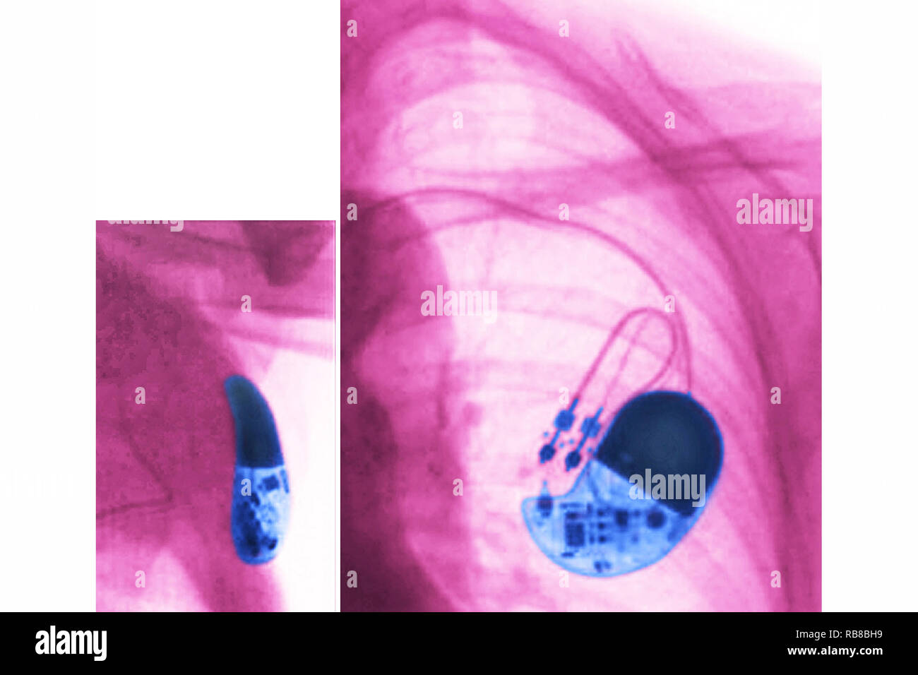 Pacemaker hi-res stock photography and images - Alamy