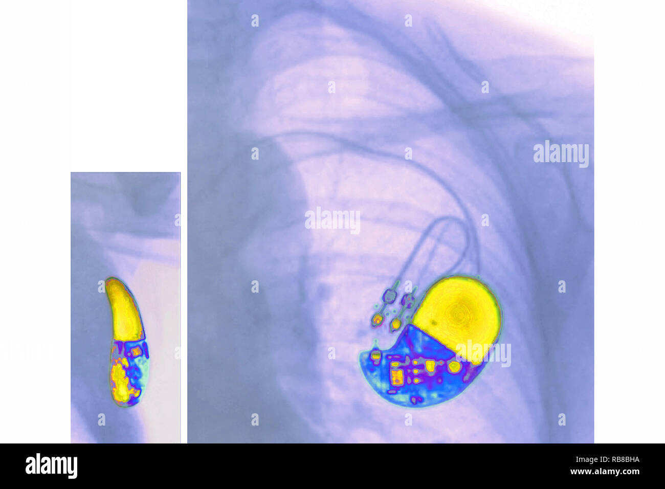 Artificial pacemaker hi-res stock photography and images - Alamy