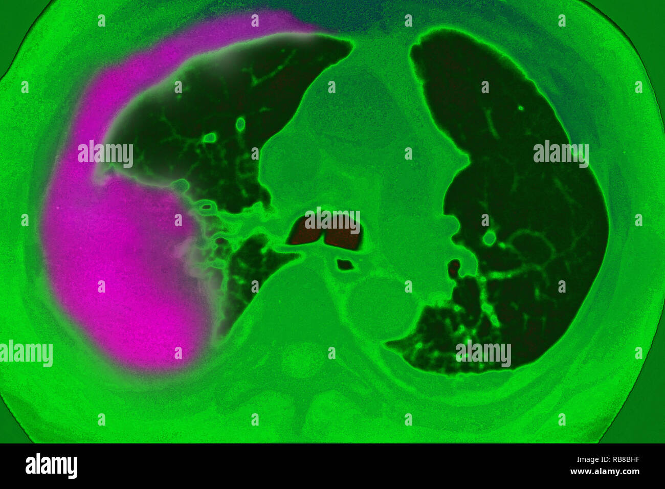 PLEURISY CT SCAN Stock Photo - Alamy