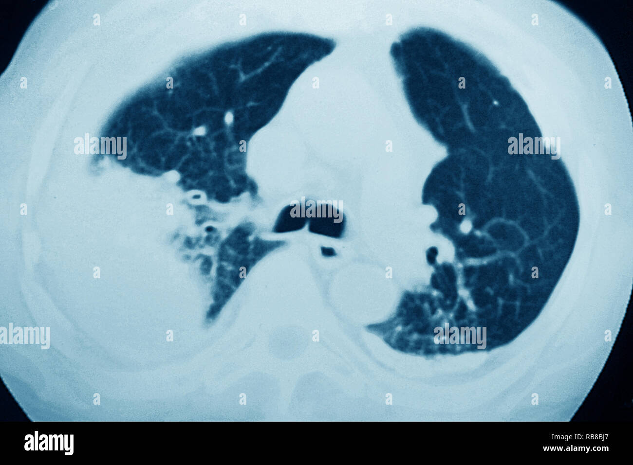 PLEURISY CT SCAN Stock Photo - Alamy