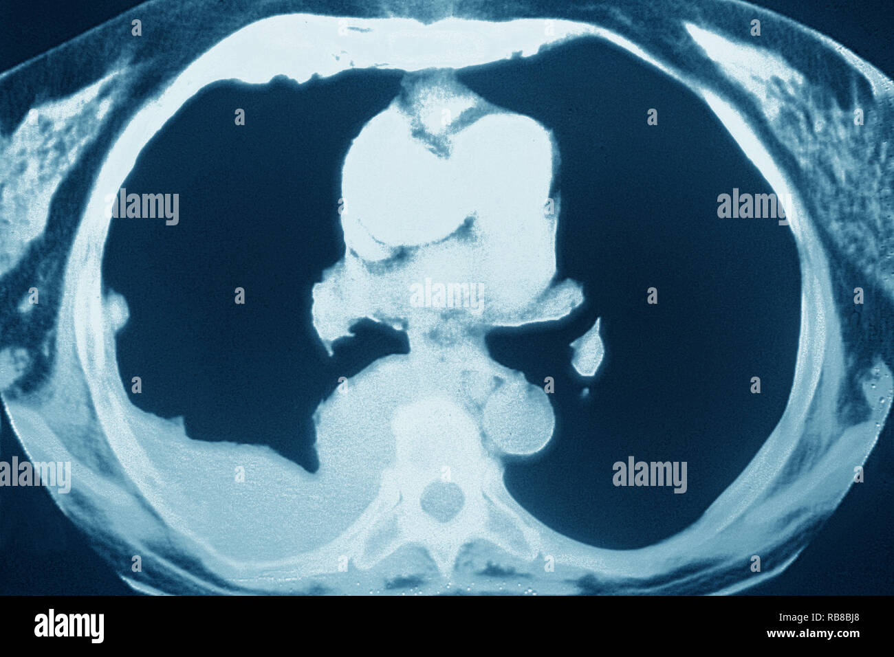 PLEURISY CT SCAN Stock Photo - Alamy