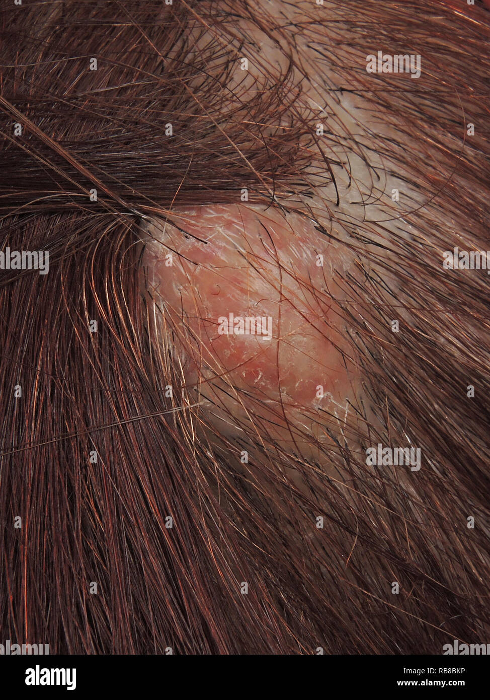 Epidermoid Cyst Pictures