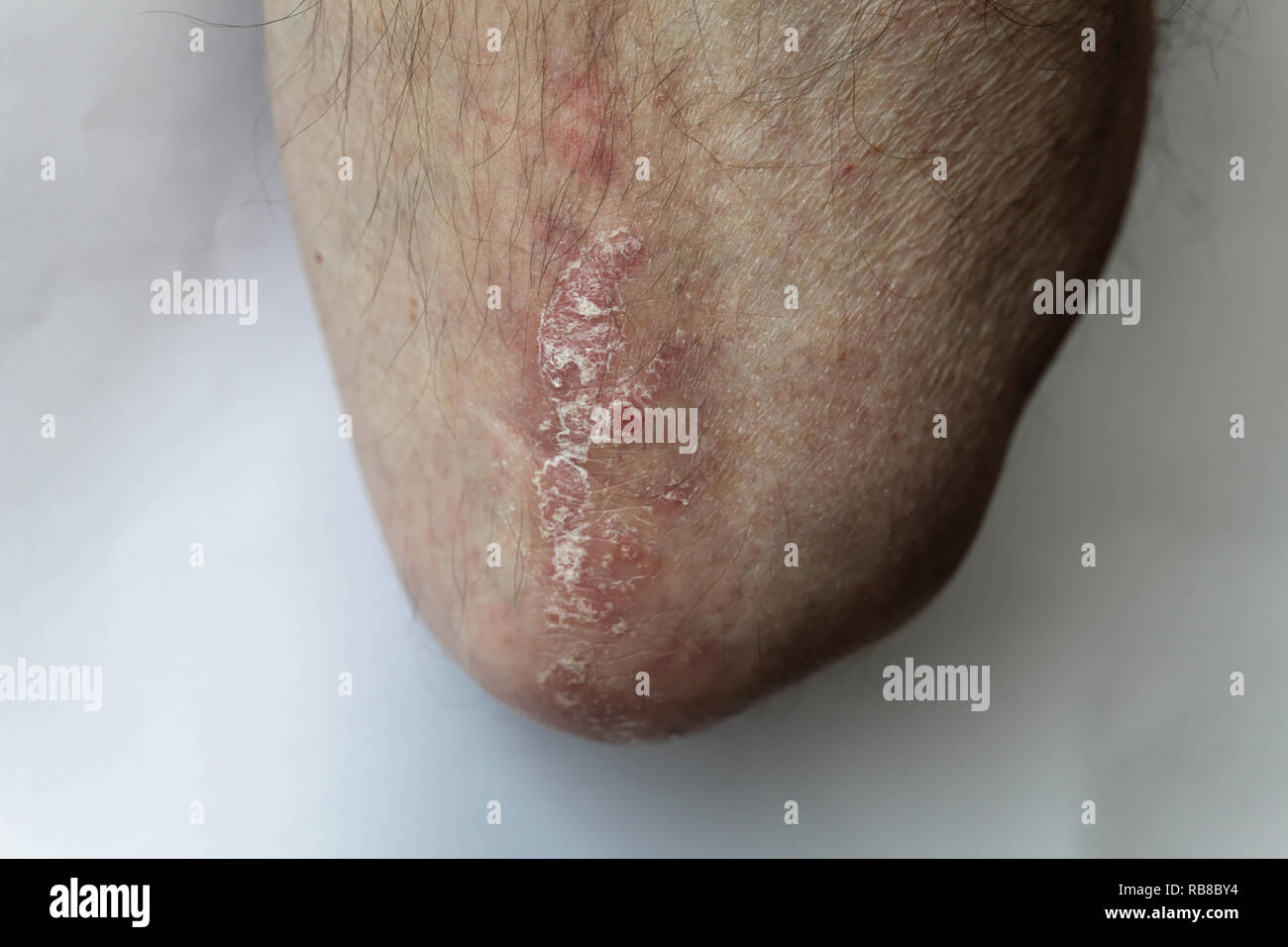 Psoriasis elbow hi-res stock photography and images - Alamy