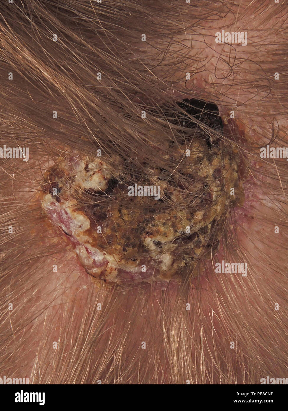 Basal cell hi-res stock photography and images - Alamy
