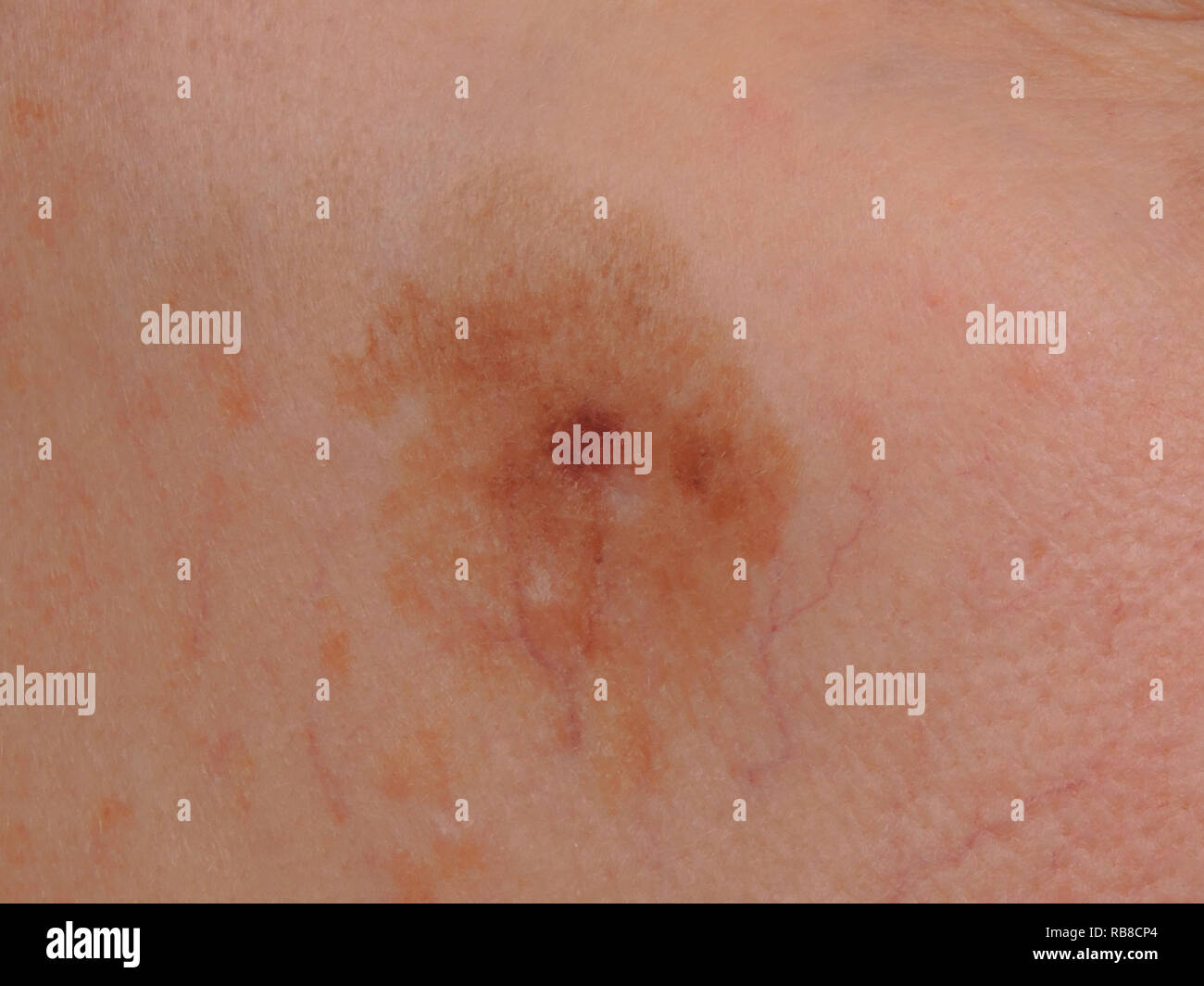 Malignant melanoma face hi-res stock photography and images - Alamy