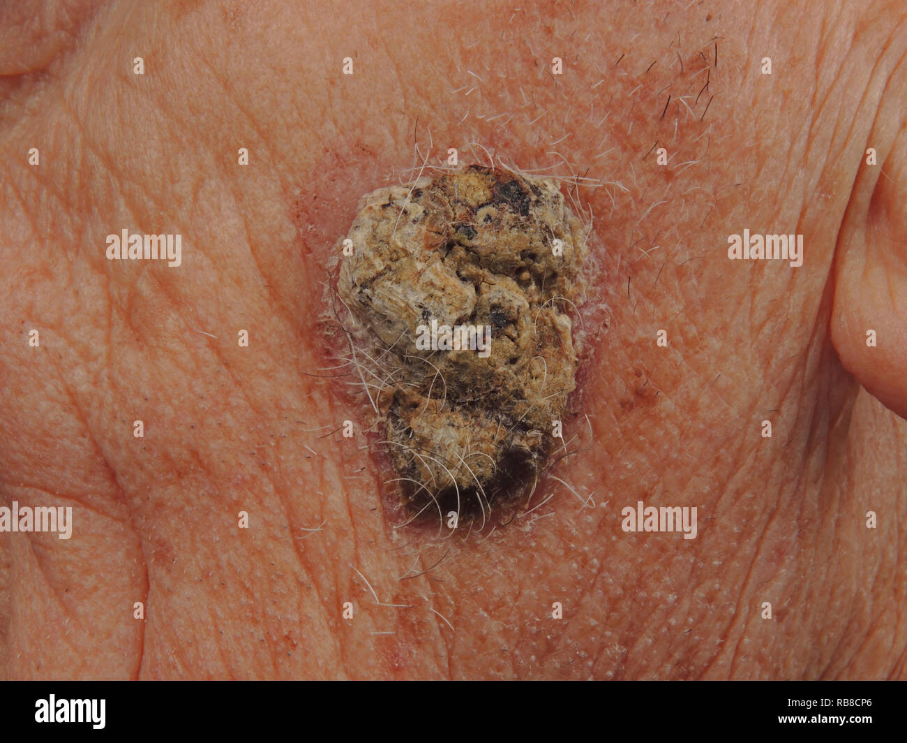 Cheek Epithelial Cells Under Microscope