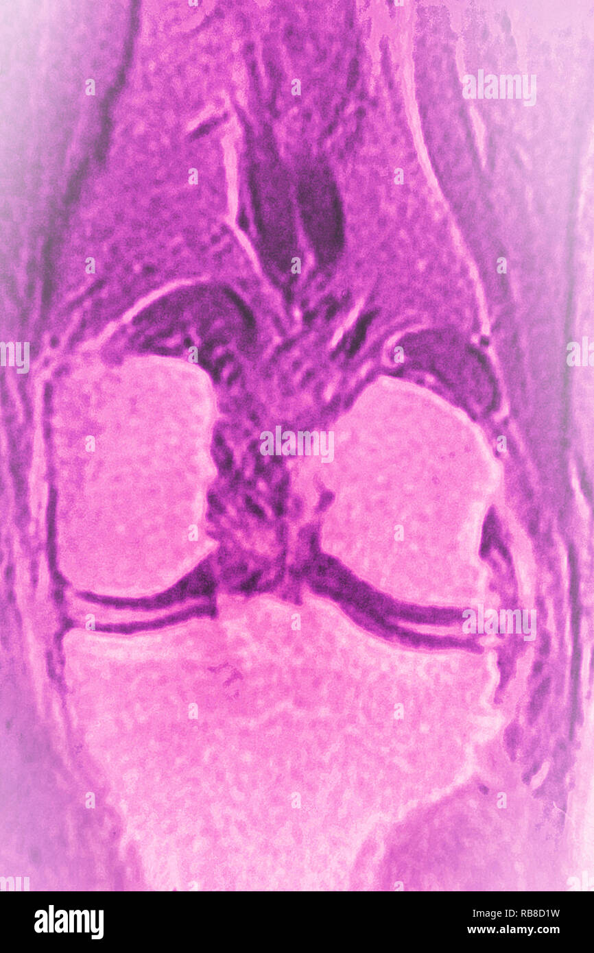 Normal knee hi-res stock photography and images - Alamy