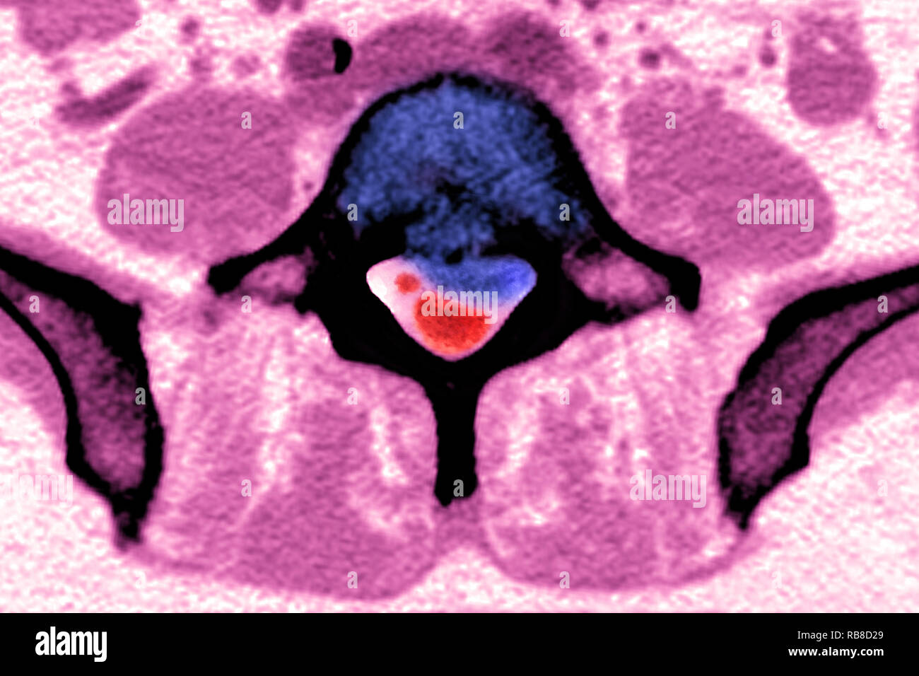 Ponytail syndrome hi-res stock photography and images - Alamy