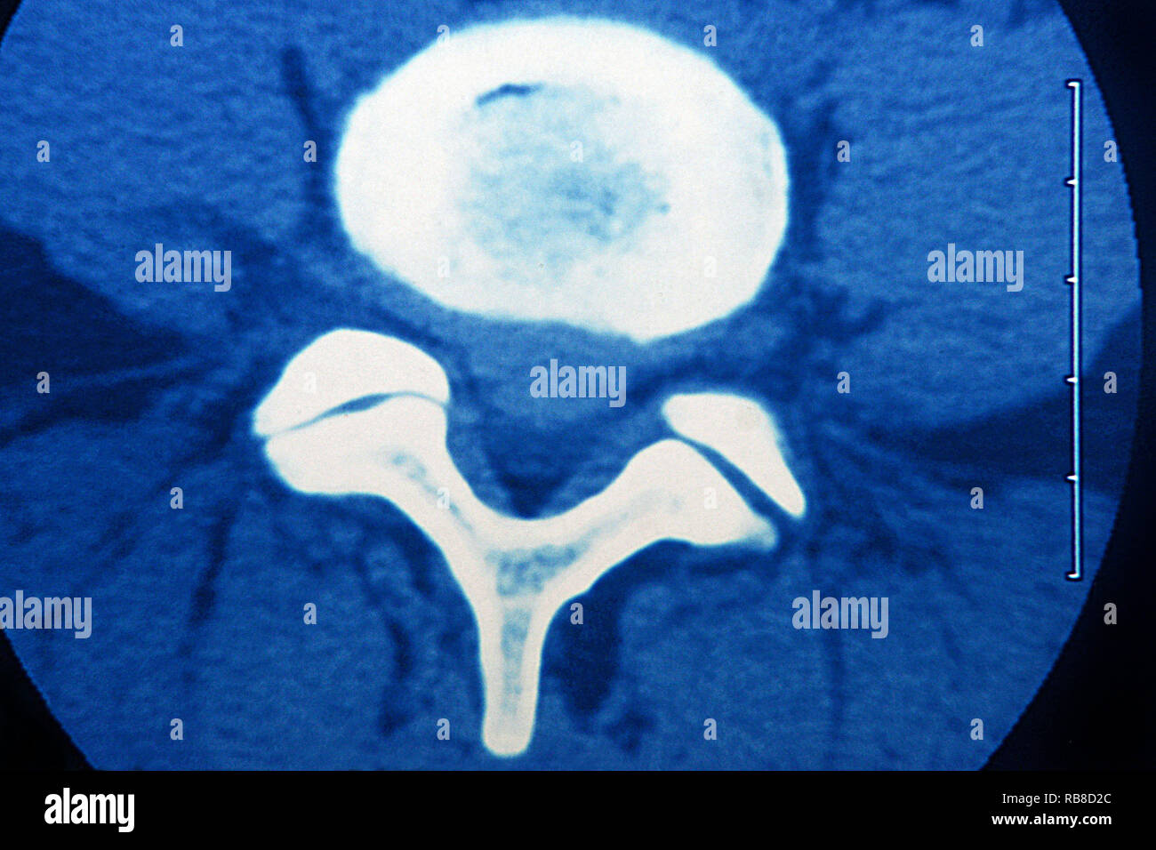 Vertebral disc hi-res stock photography and images - Alamy