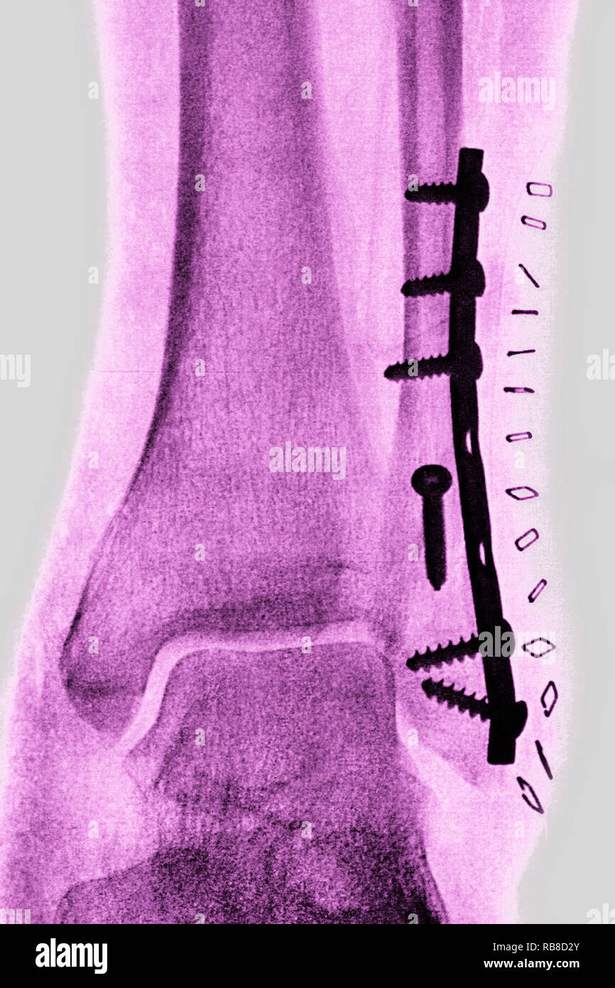 Fracture Of Tibia And Fibula High Resolution Stock Photography and ...