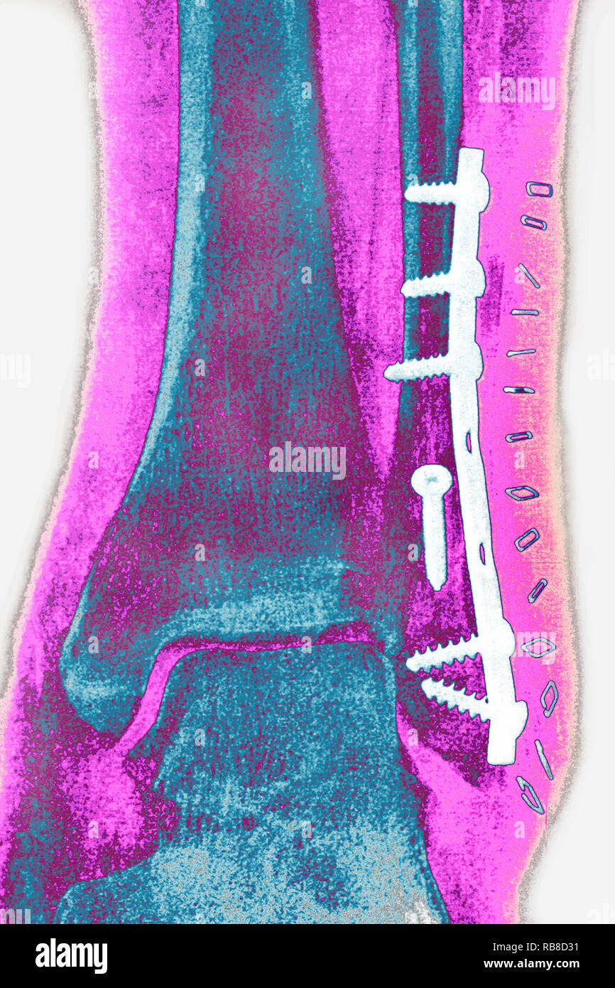 Osteosynthesis on a fracture of the fibula Stock Photo - Alamy