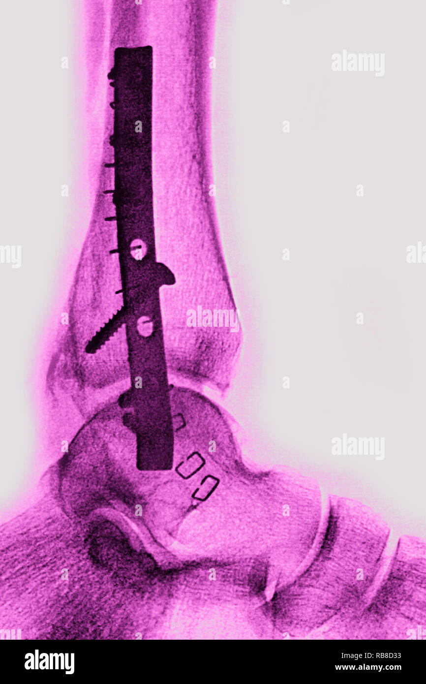 Osteosynthesis on a fracture of the fibula Stock Photo - Alamy