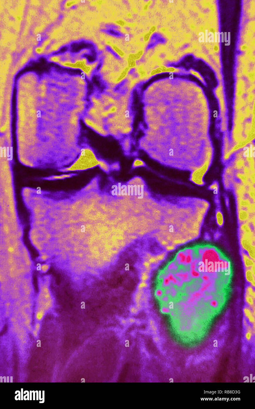 Sarcoma Leg High Resolution Stock Photography and Images - Alamy