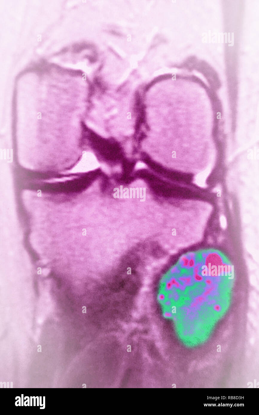 Sarcoma Leg High Resolution Stock Photography and Images - Alamy