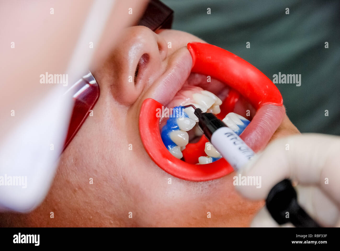 Patient with safety protective glasses and cheek retractor on. Laser ...