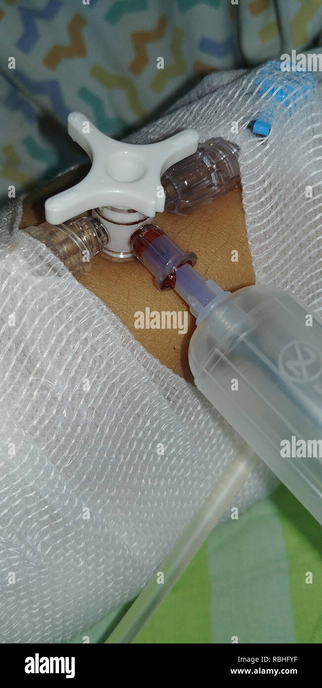 Intravenous infusion hi-res stock photography and images - Alamy