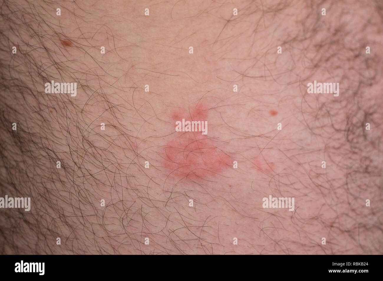 Herpes zoster rash blisters hi-res stock photography and images - Alamy