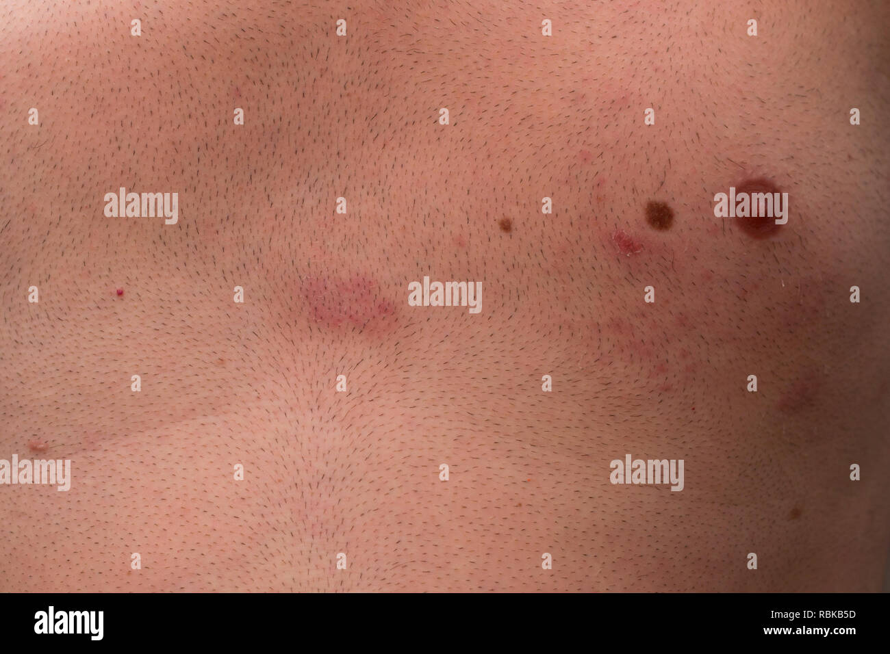 Shingles disease, herpes zoster, blisters on body, varicella-zoster ...