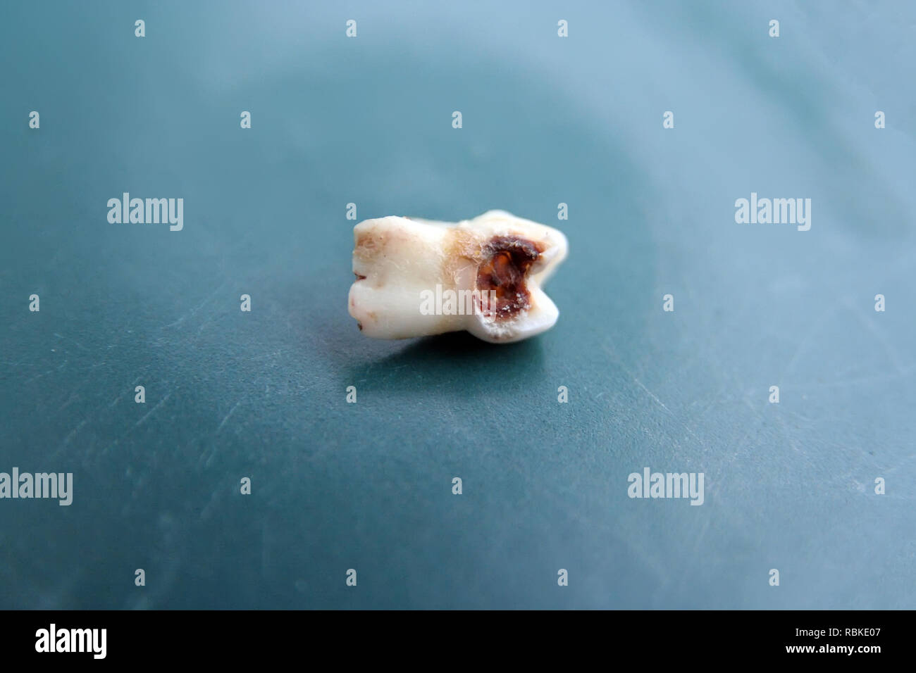 Rotten tooth. Bad tooth. Extracted rotten tooth Stock Photo - Alamy