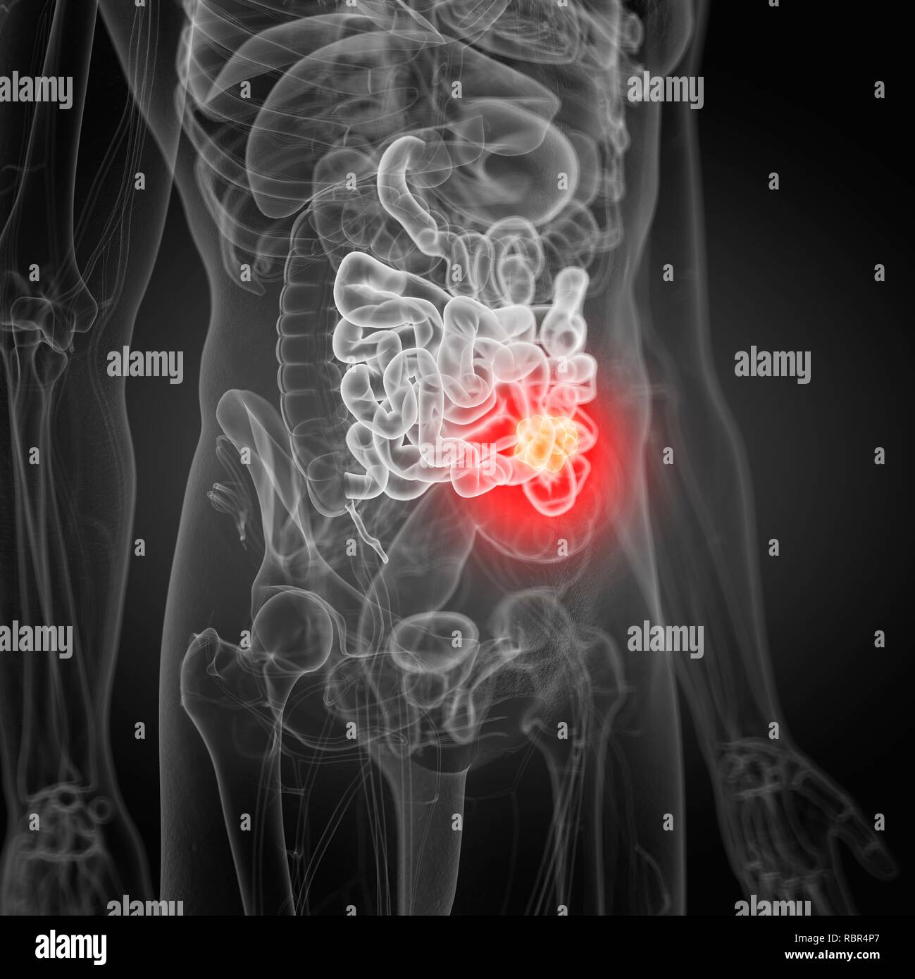 Illustration of small intestine cancer Stock Photo - Alamy