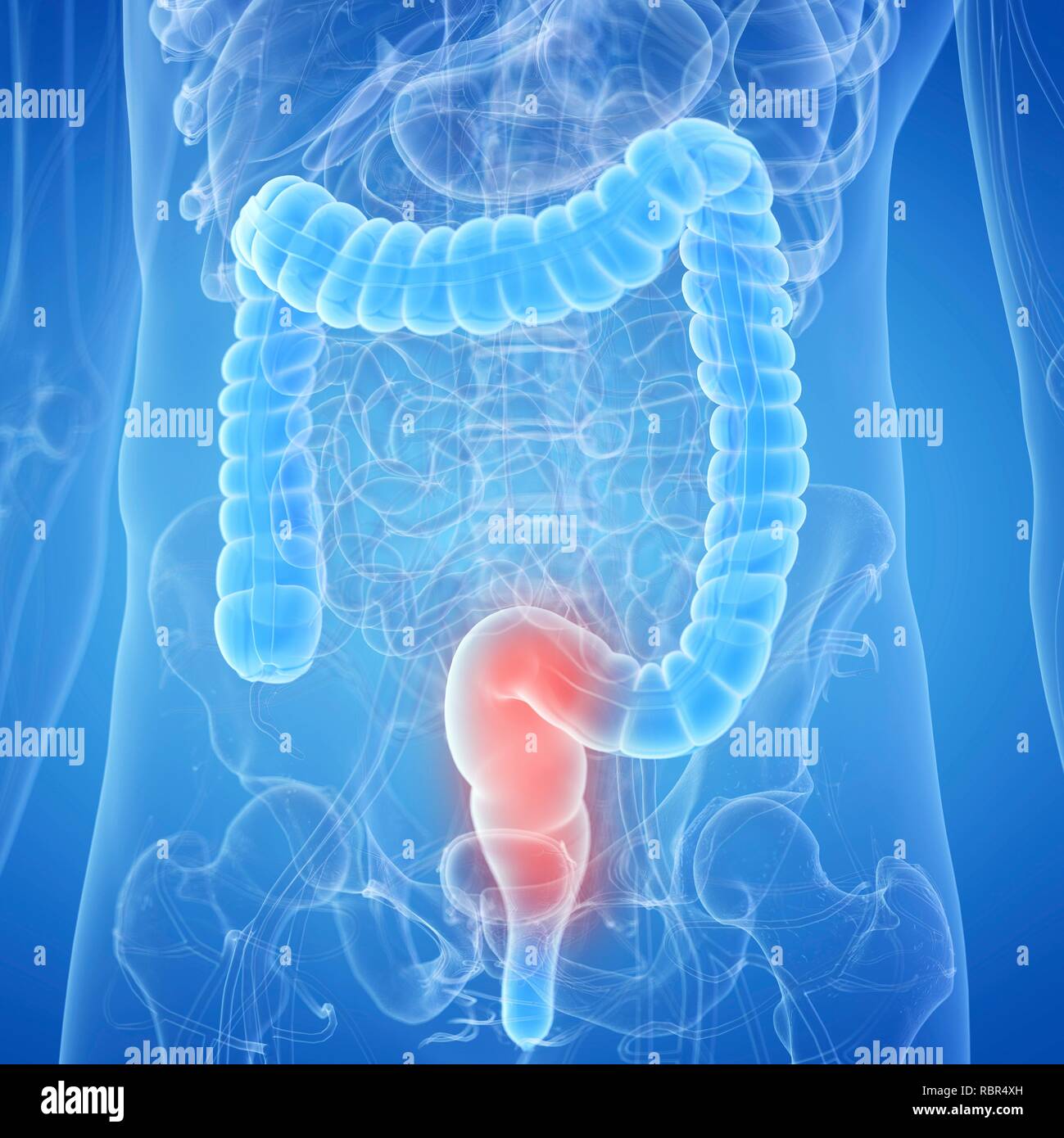 Illustration of an inflamed rectum Stock Photo - Alamy