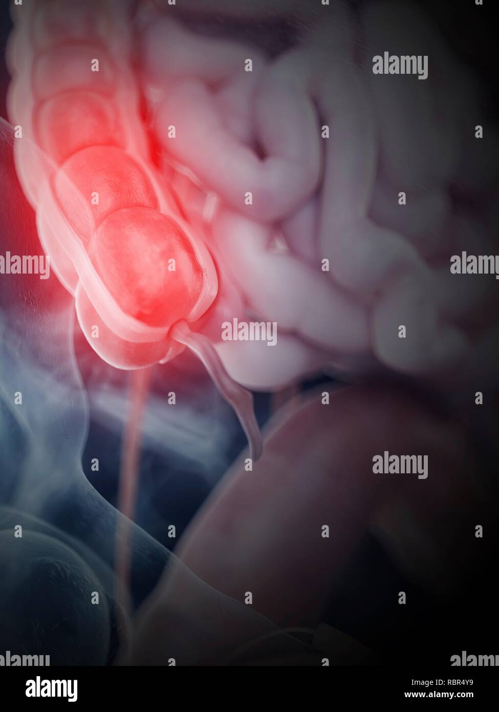 Inflamed colon hi-res stock photography and images - Alamy