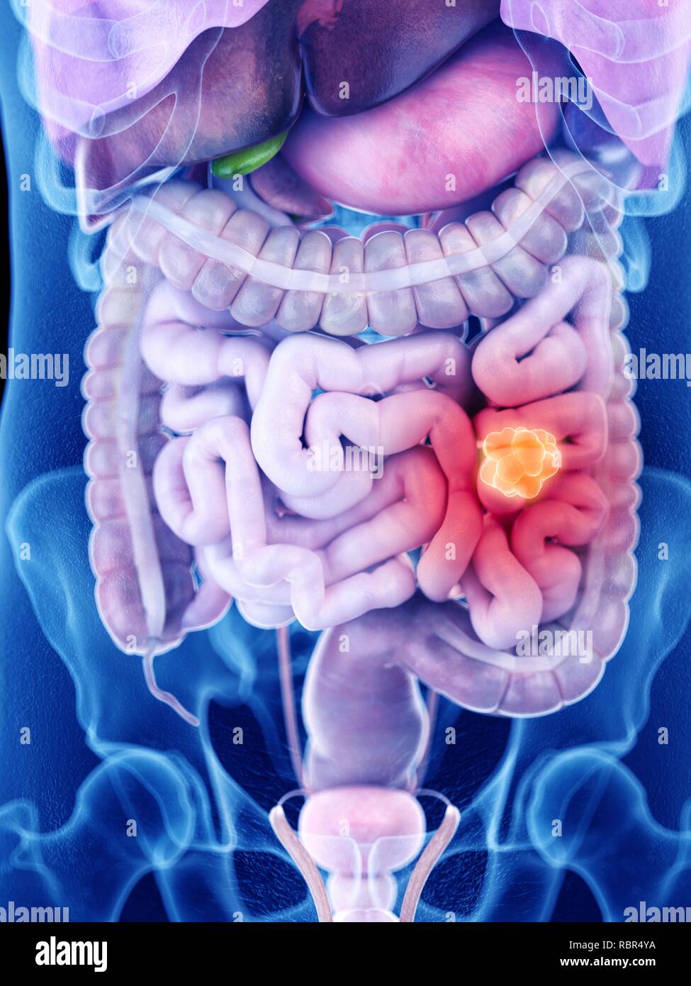 Illustration of intestine cancer Stock Photo - Alamy