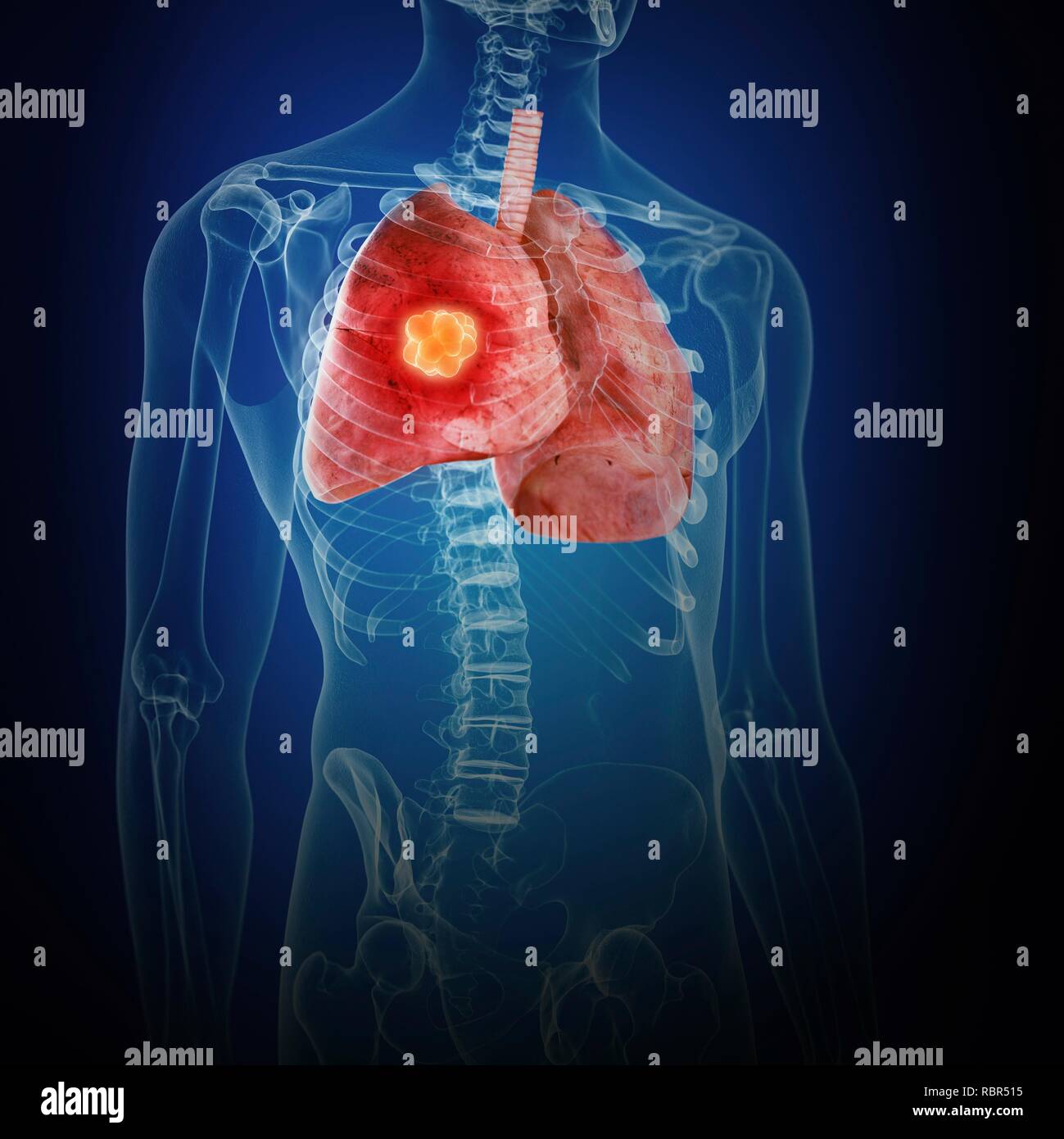 Illustration of lung cancer Stock Photo - Alamy