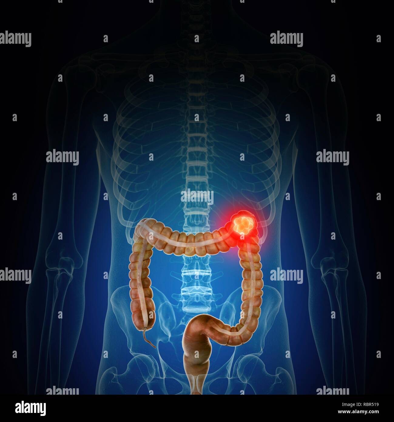 Illustration of colon cancer Stock Photo - Alamy