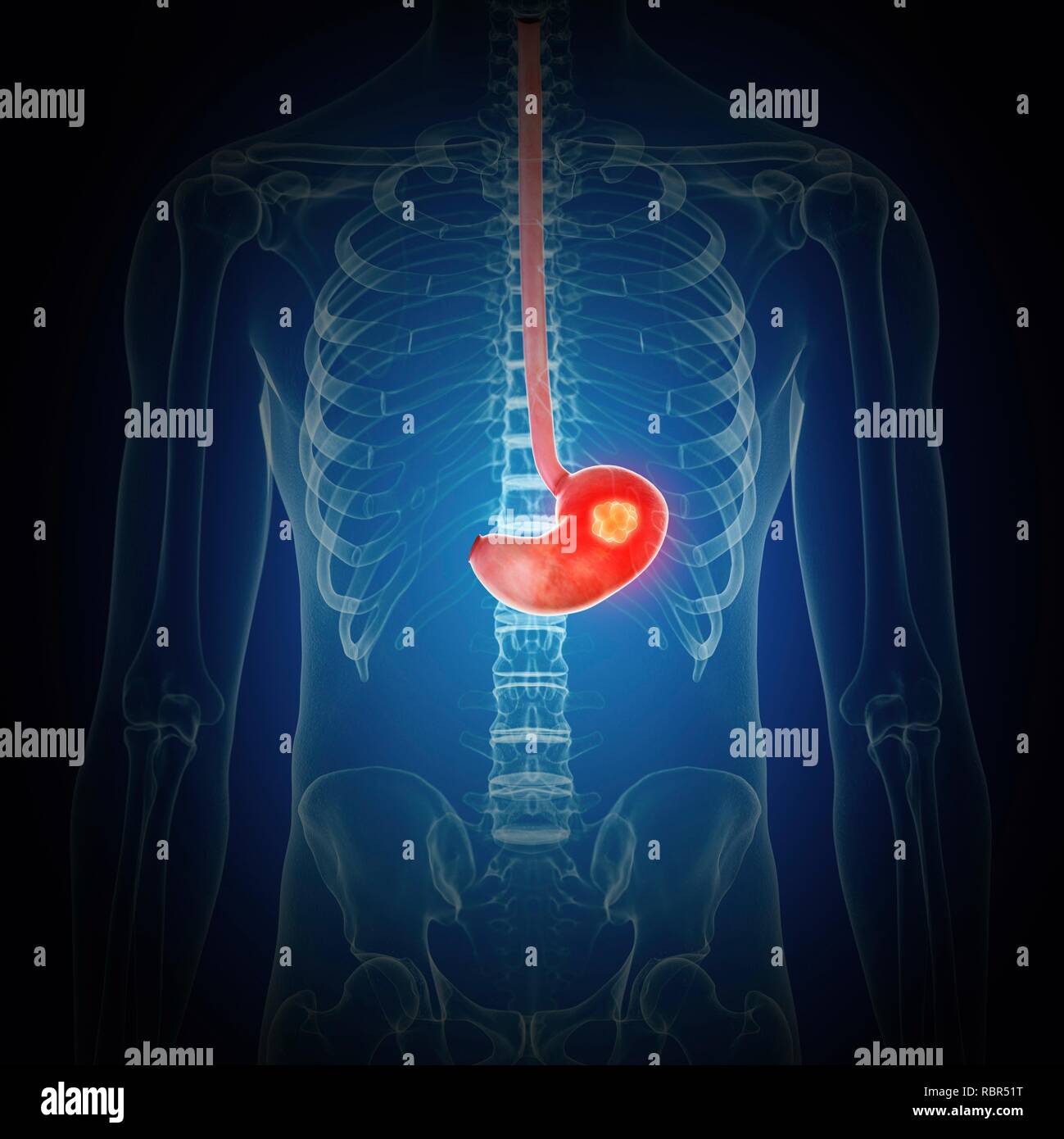 Illustration of stomach cancer Stock Photo - Alamy