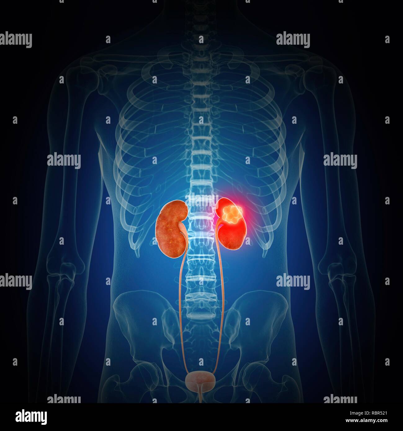Illustration of kidney cancer Stock Photo - Alamy