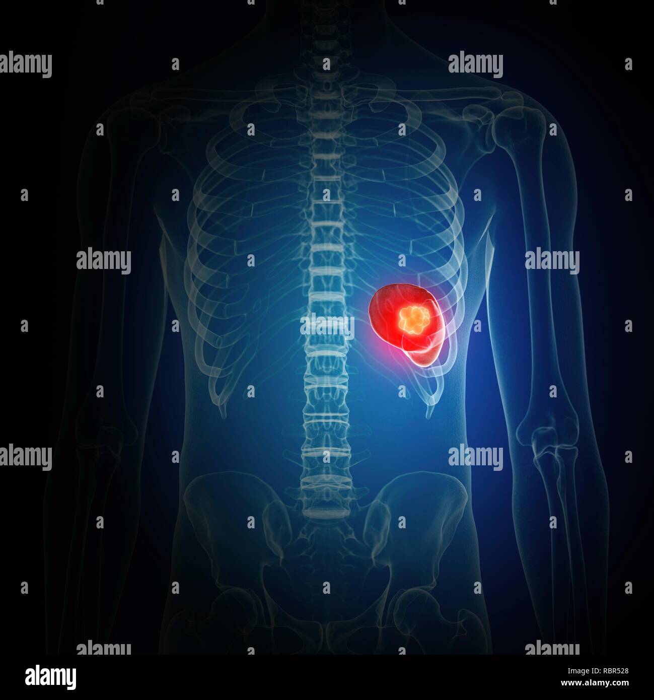 Illustration of spleen cancer Stock Photo - Alamy