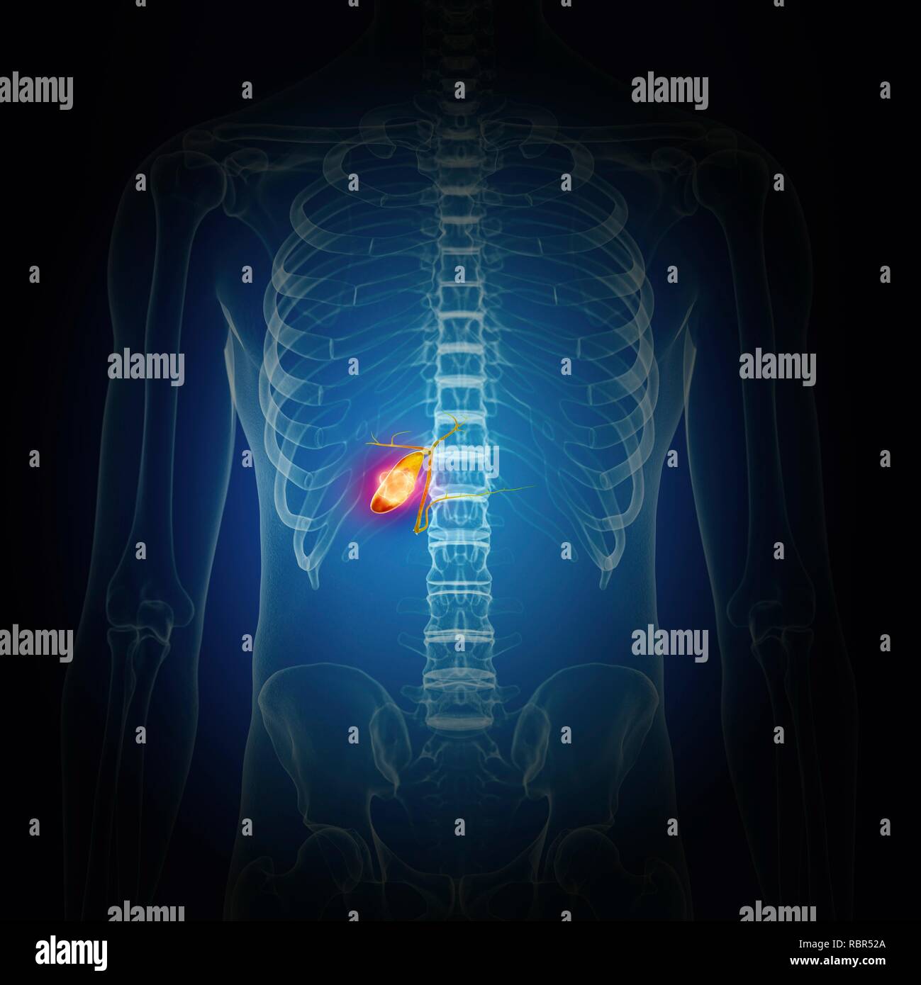 Illustration of gallbladder cancer Stock Photo - Alamy