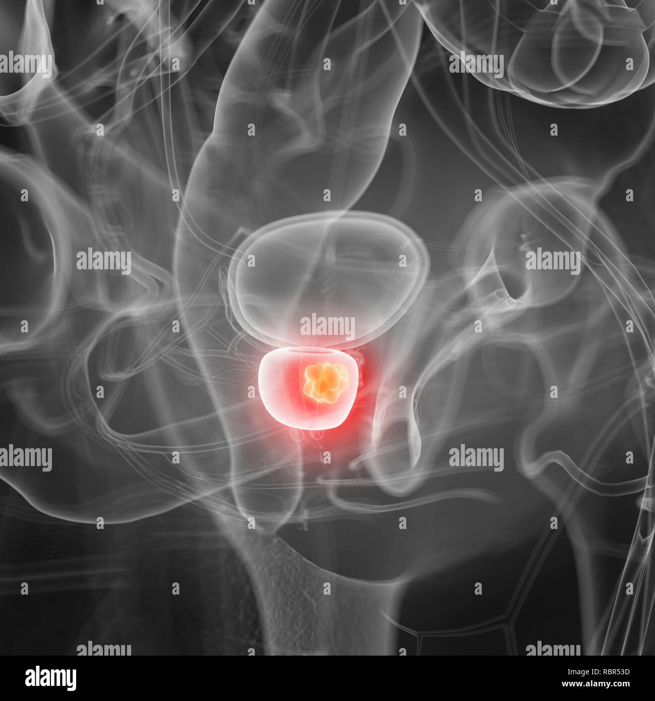Illustration of prostate cancer Stock Photo - Alamy