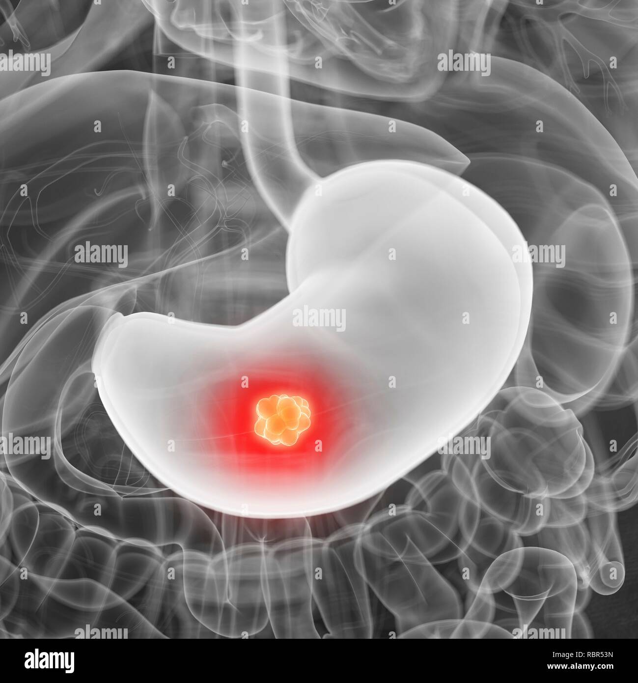 Illustration of stomach cancer Stock Photo - Alamy