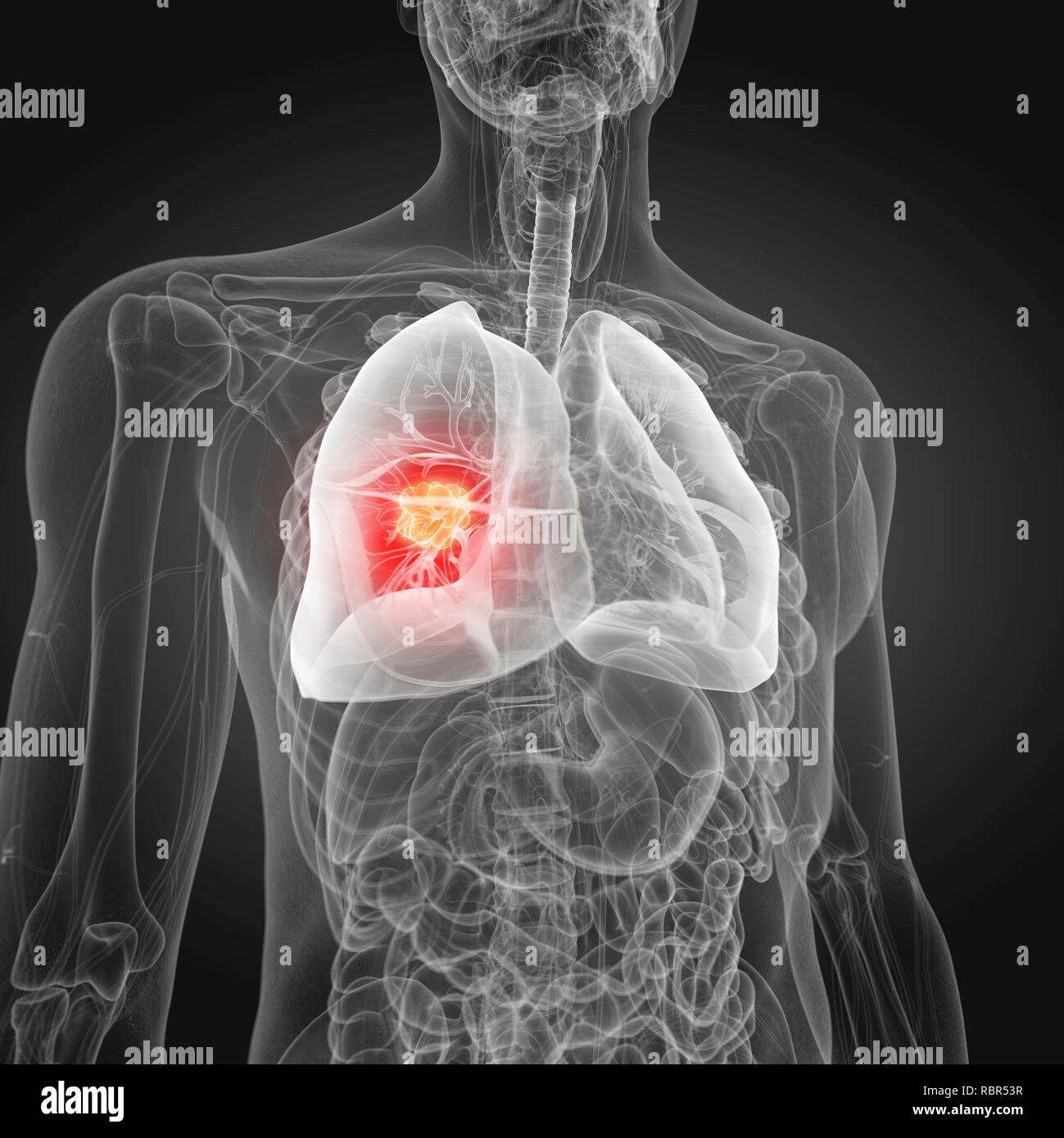 Illustration of lung cancer Stock Photo - Alamy