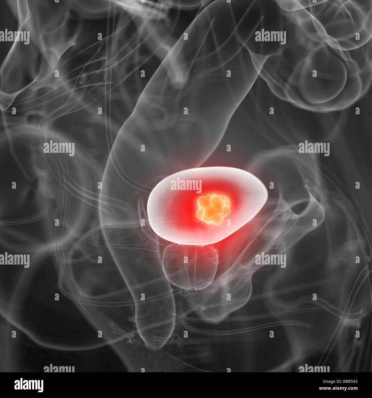Illustration of bladder cancer Stock Photo - Alamy