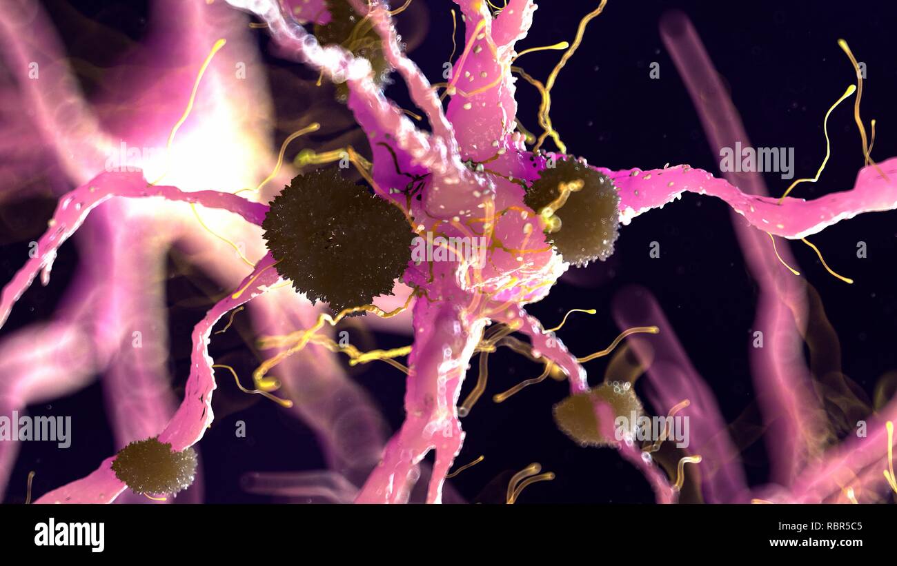 Illustration of amyloid plaques on a nerve cell Stock Photo - Alamy