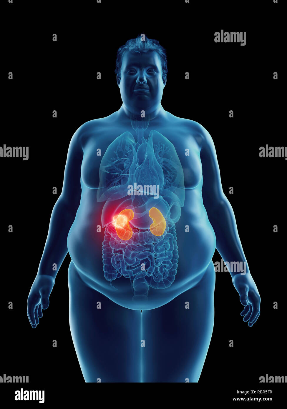 Illustration of an obese man's kidney tumor Stock Photo - Alamy