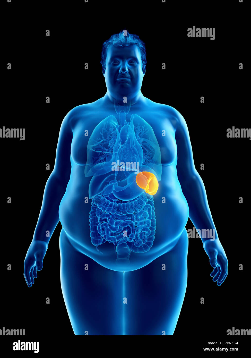 Illustration of an obese man's spleen Stock Photo - Alamy
