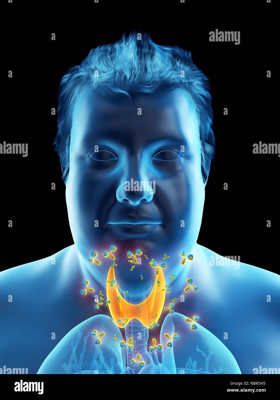 Illustration of an autoimmune thyroid disease Stock Photo - Alamy