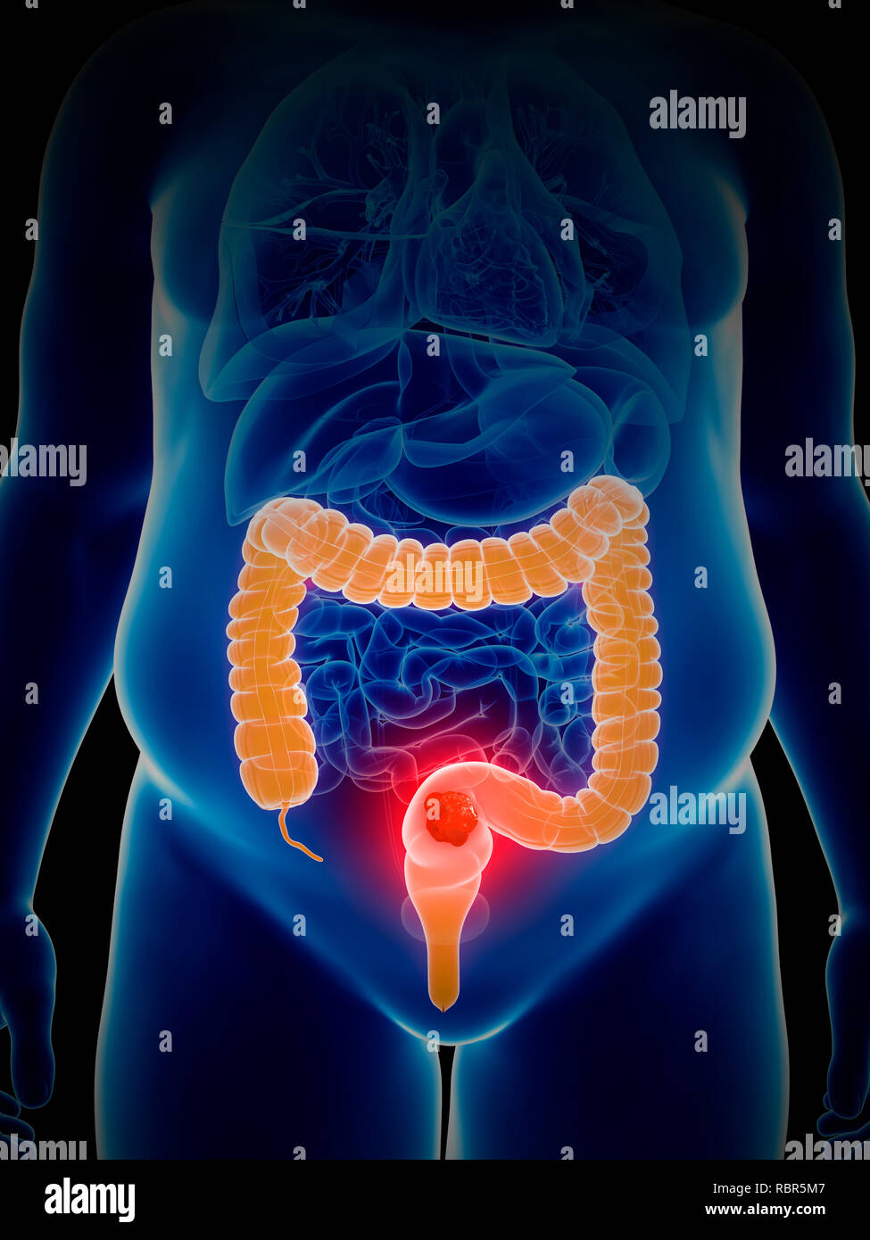 Illustration of colon cancer Stock Photo - Alamy