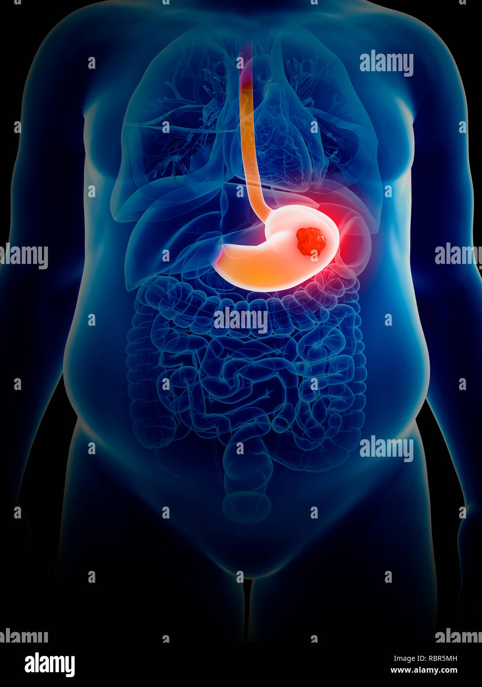 Illustration of stomach cancer Stock Photo - Alamy